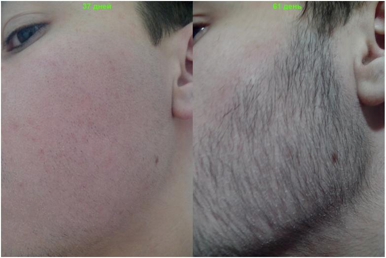 Minoxidil алерана для роста волос: лучшее решение для отращивания бороды